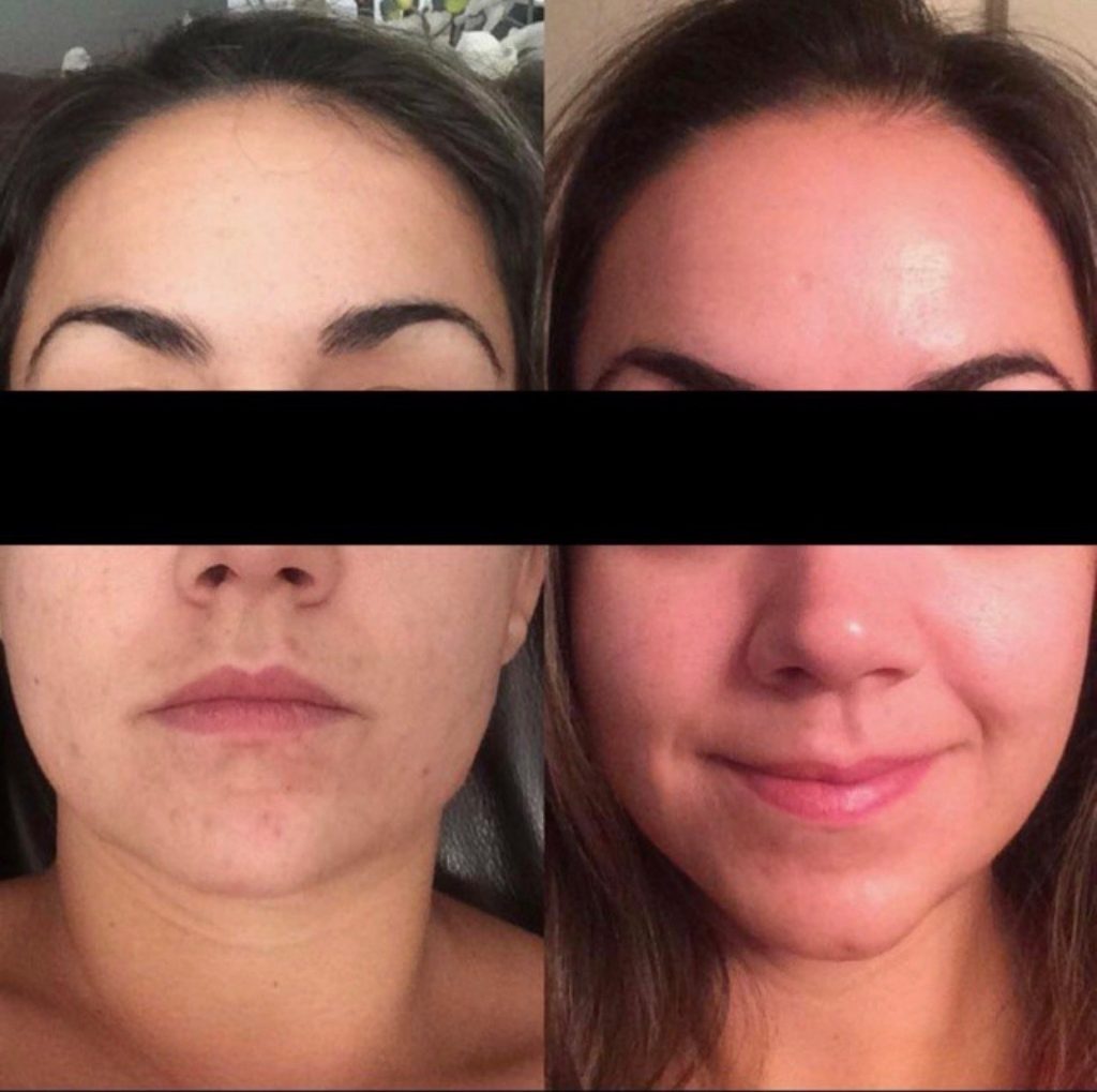 Facial peeling – Photoderma