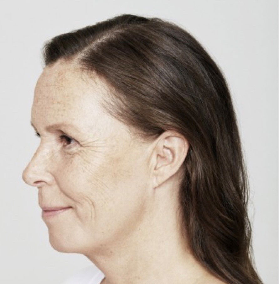 Botox/Injection – Photoderma